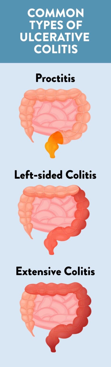 Ulcerative Colitis - National Association For Continence