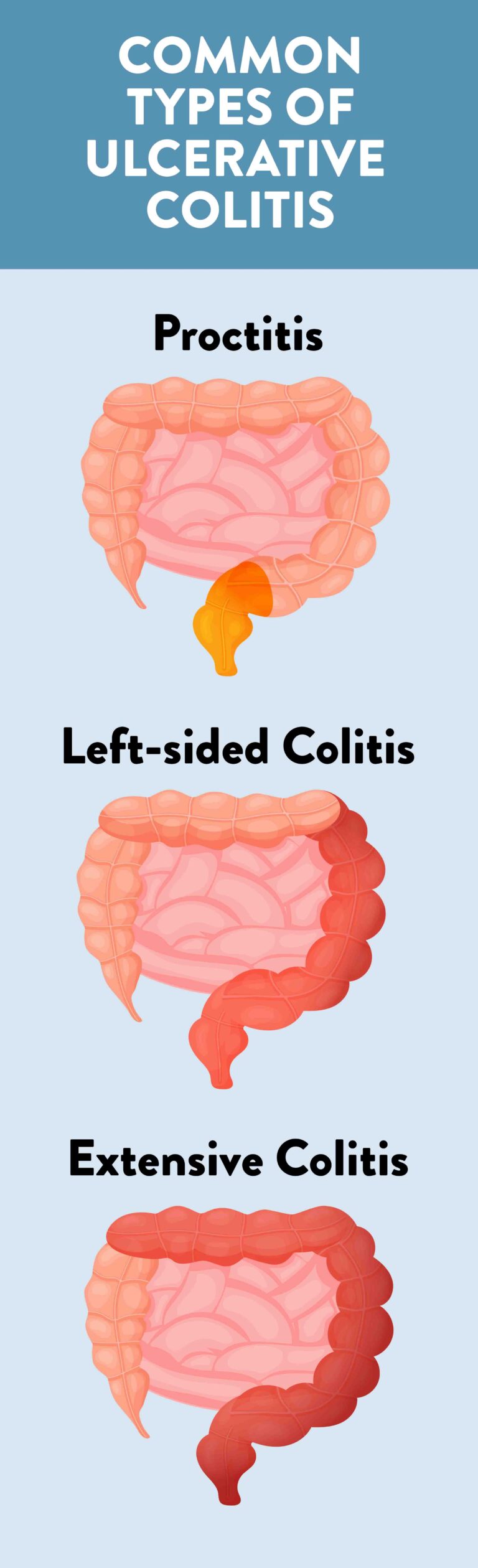 Ulcerative Colitis - National Association For Continence
